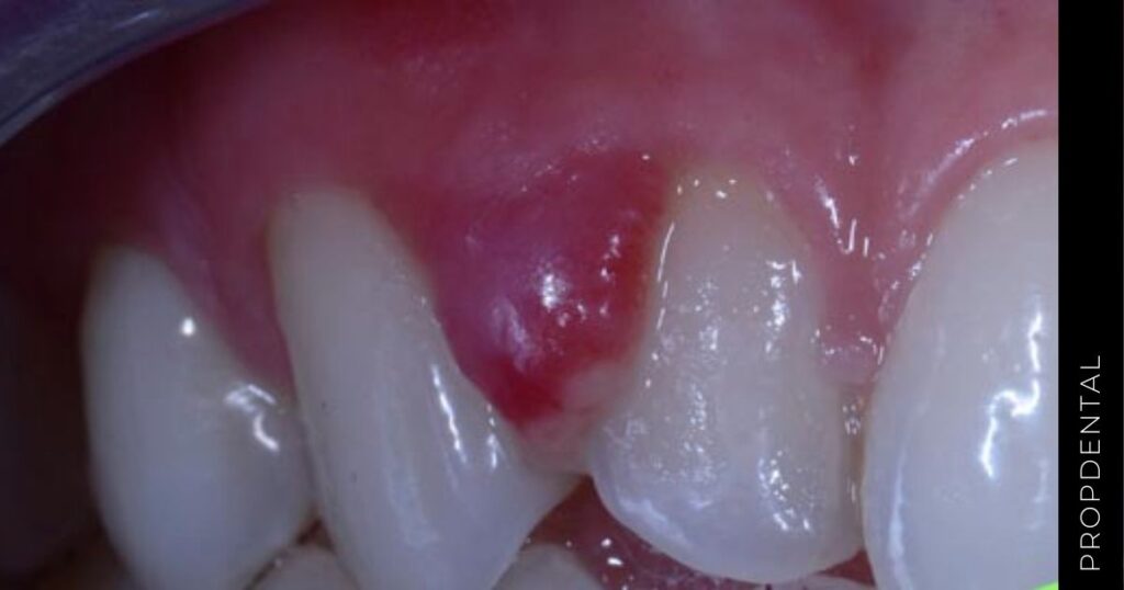 ¿Que es el absceso periapical? ¿Tienes un dolor es profundo y flemón?