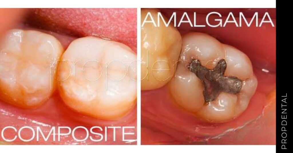 Diferencias entre empastes de amalgama y composite